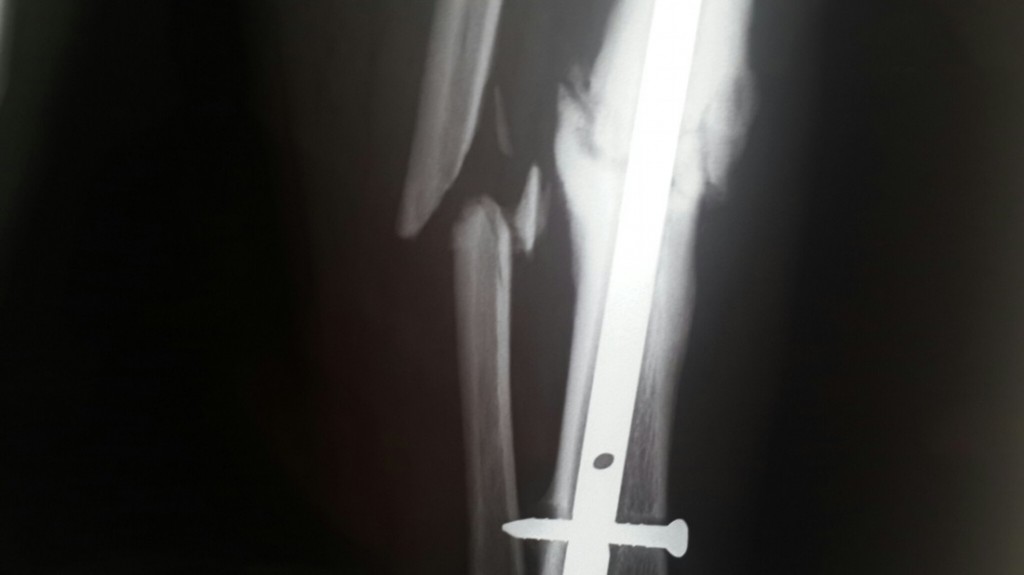 Fracture Non Union Treatment | Ortho Biologic Surgery India