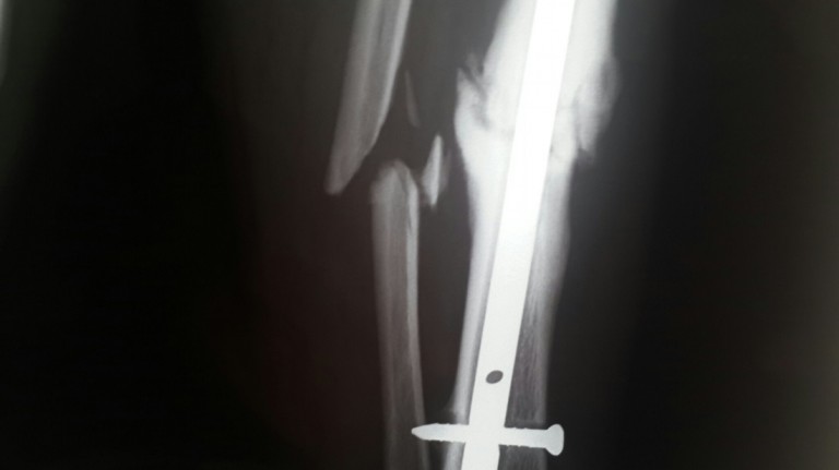 Fracture Non Union Treatment | Ortho Biologic Surgery India