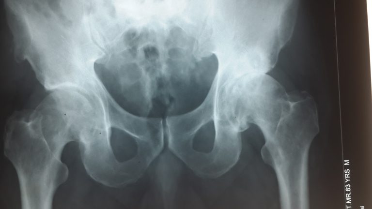 Hip osteo-arthritis India- Stem cell treatment | Ortho Biologic Surgery ...